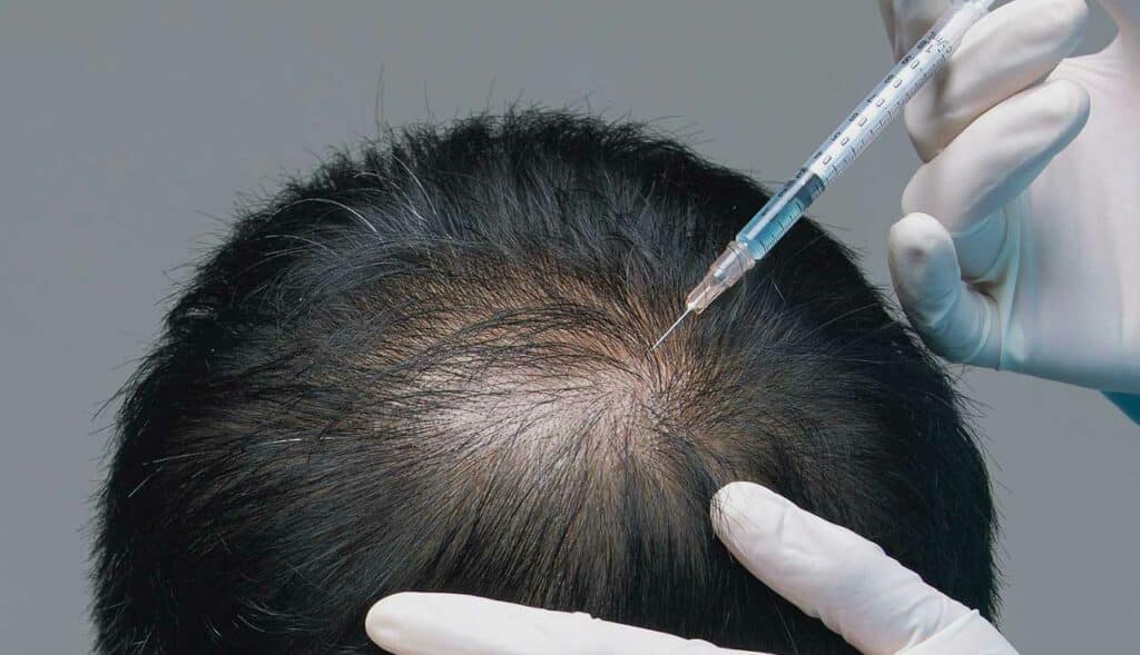 Non-Surgical Hair Restoration | Burbank Hair Transplant California